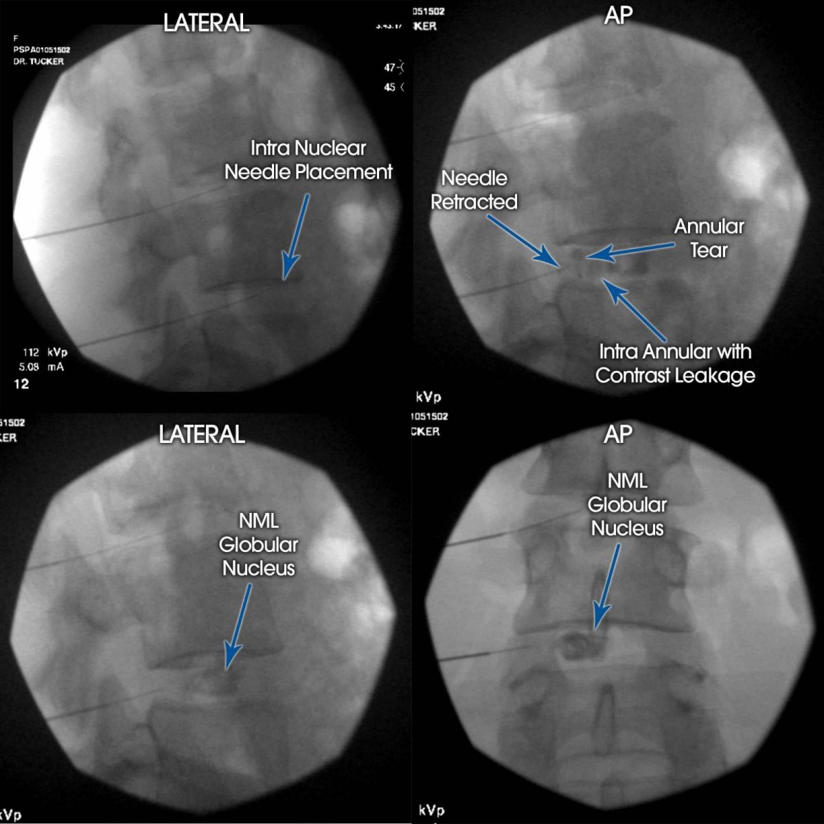 Disc Tears | Treatments | Carolinas